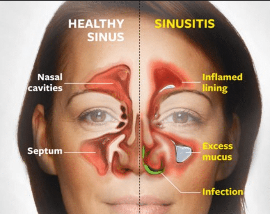 Post Nasal Drip And Enlarged Lymph Nodes Infoupdate